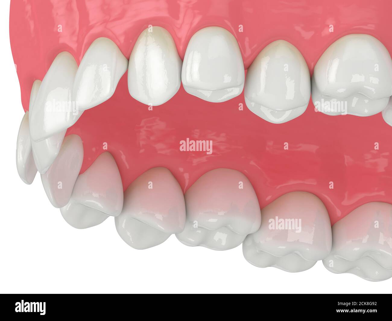 3d render of upper jaw with abnormal teeth position. Orthodontic ...