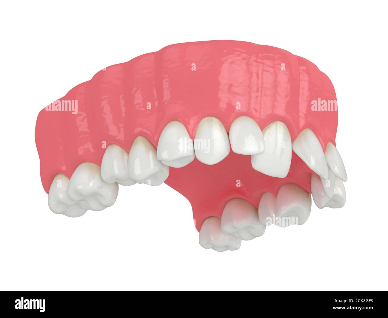 3d render of upper jaw with abnormal teeth position. Orthodontic ...