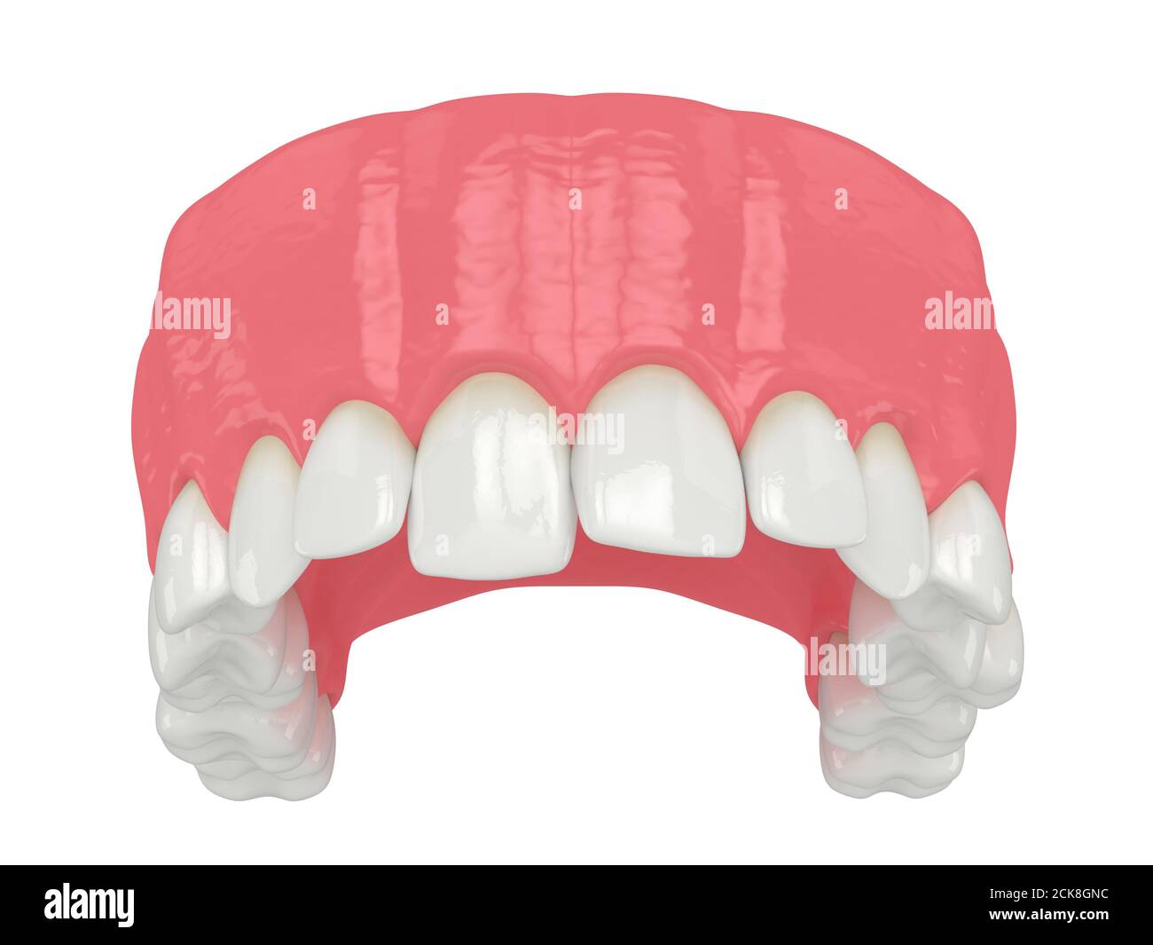 3d render of upper jaw with abnormal teeth position. Orthodontic ...