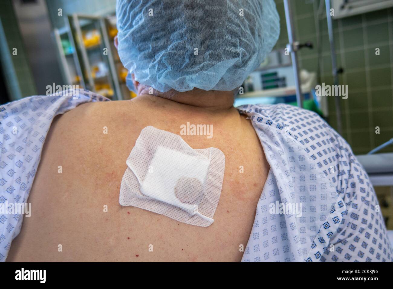 a patient has a large abscess on his back Stock Photo - Alamy