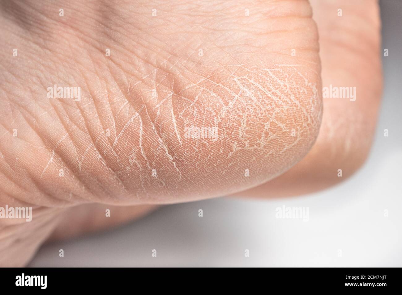 Dry and cracked soles of feet on white background Stock Photo - Alamy