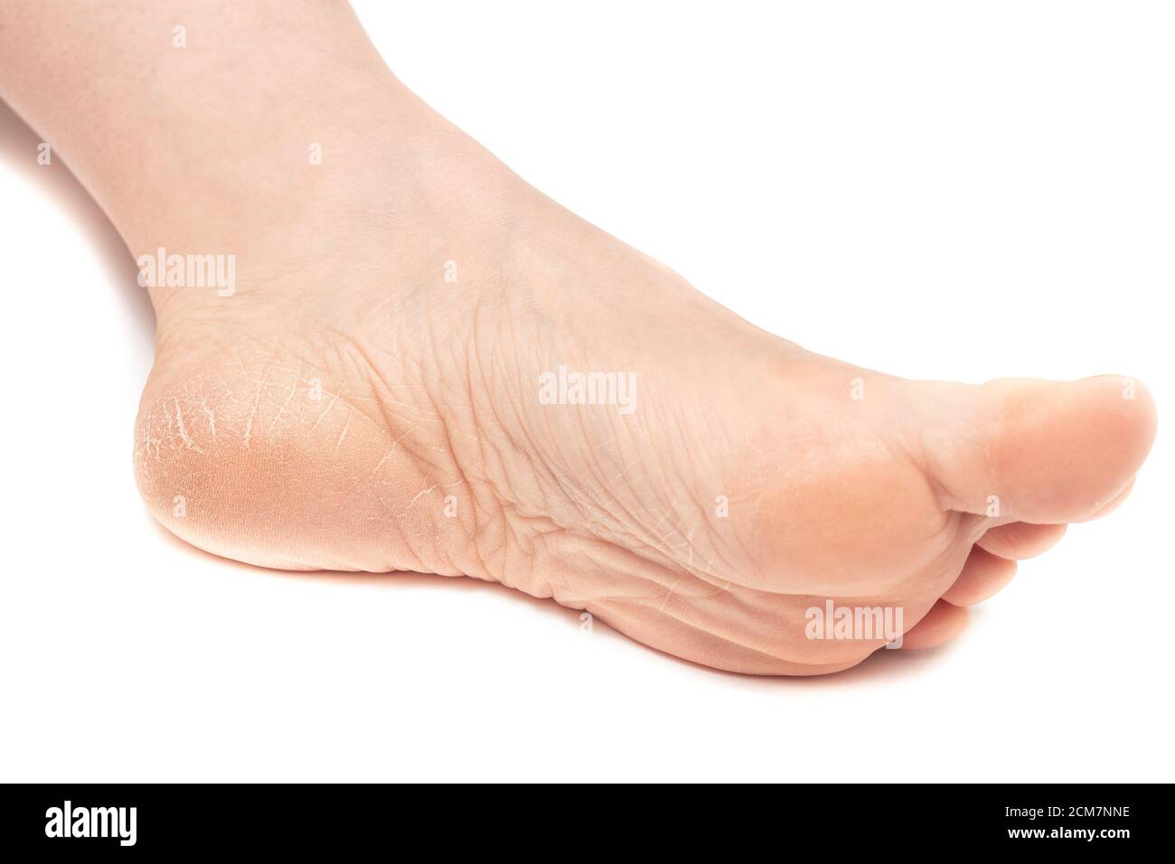 Dry and cracked soles of feet on white background Stock Photo - Alamy