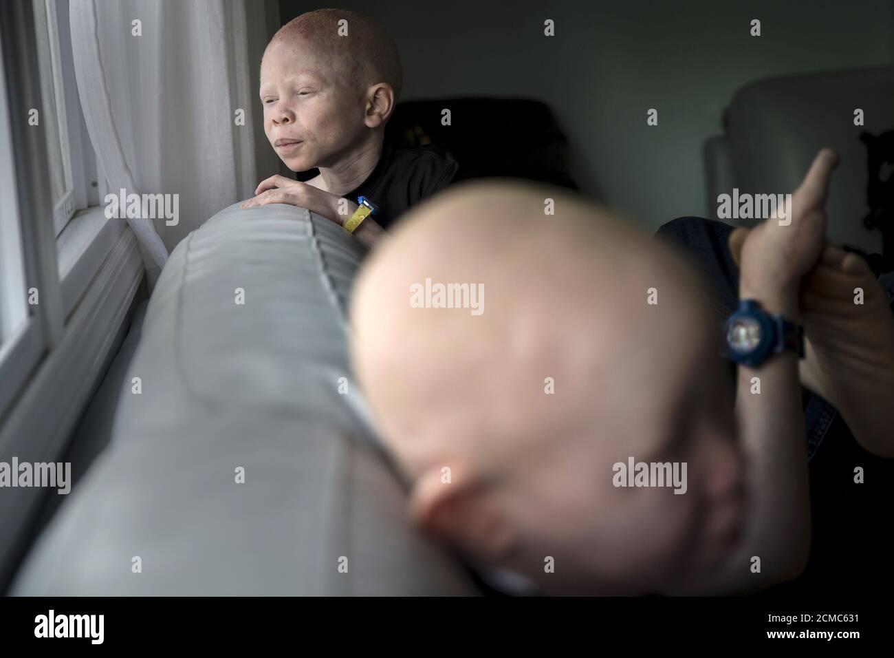 Albinism children hi-res stock photography and images - Alamy