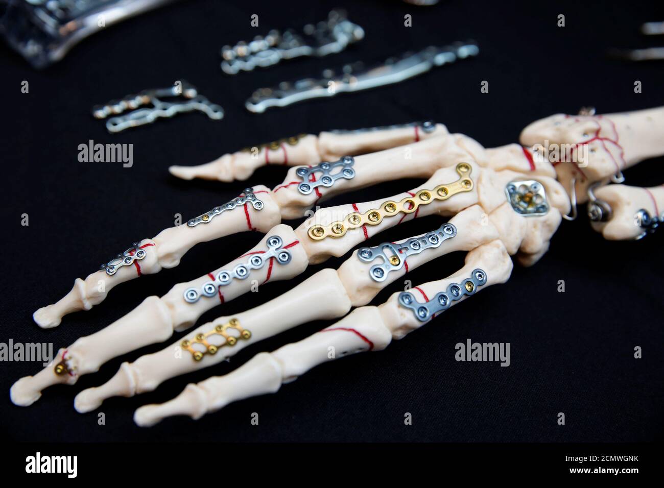 News health implants hi-res stock photography and images - Alamy