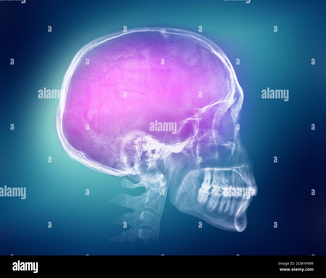 Human skull X-ray image Stock Photo - Alamy