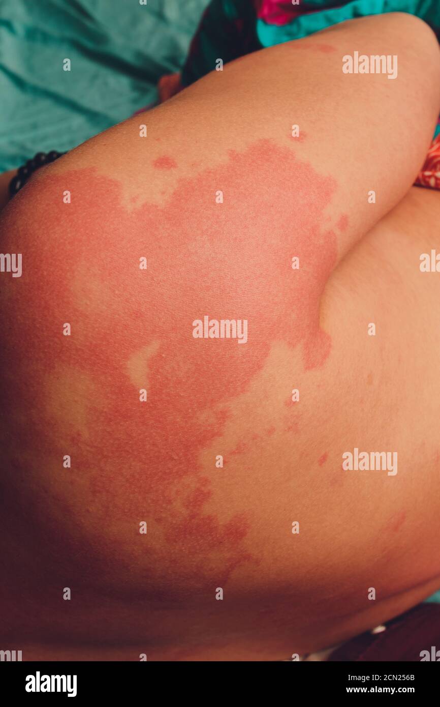 Urticaria or hives on the back, on the shoulder red rashes, itchy bumps ...