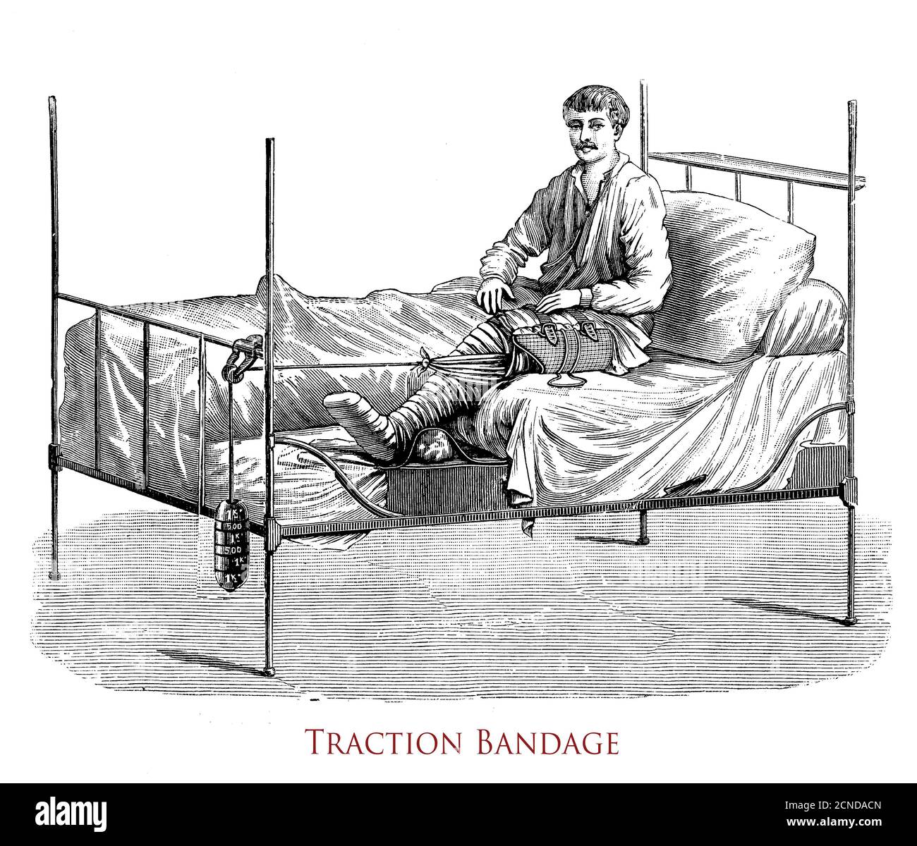 Broken Leg Traction