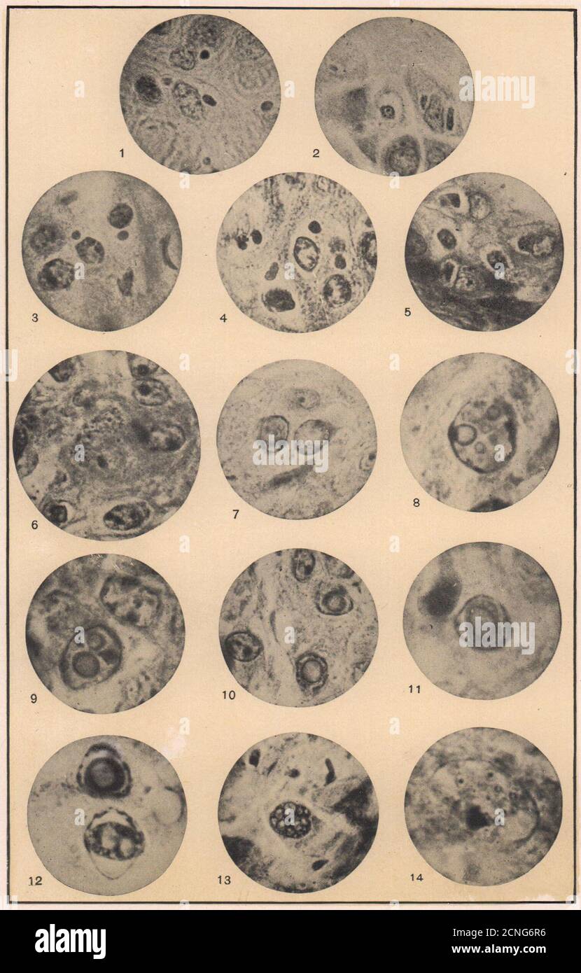 Small Pox. Medicine 1904 old antique vintage print picture Stock Photo ...
