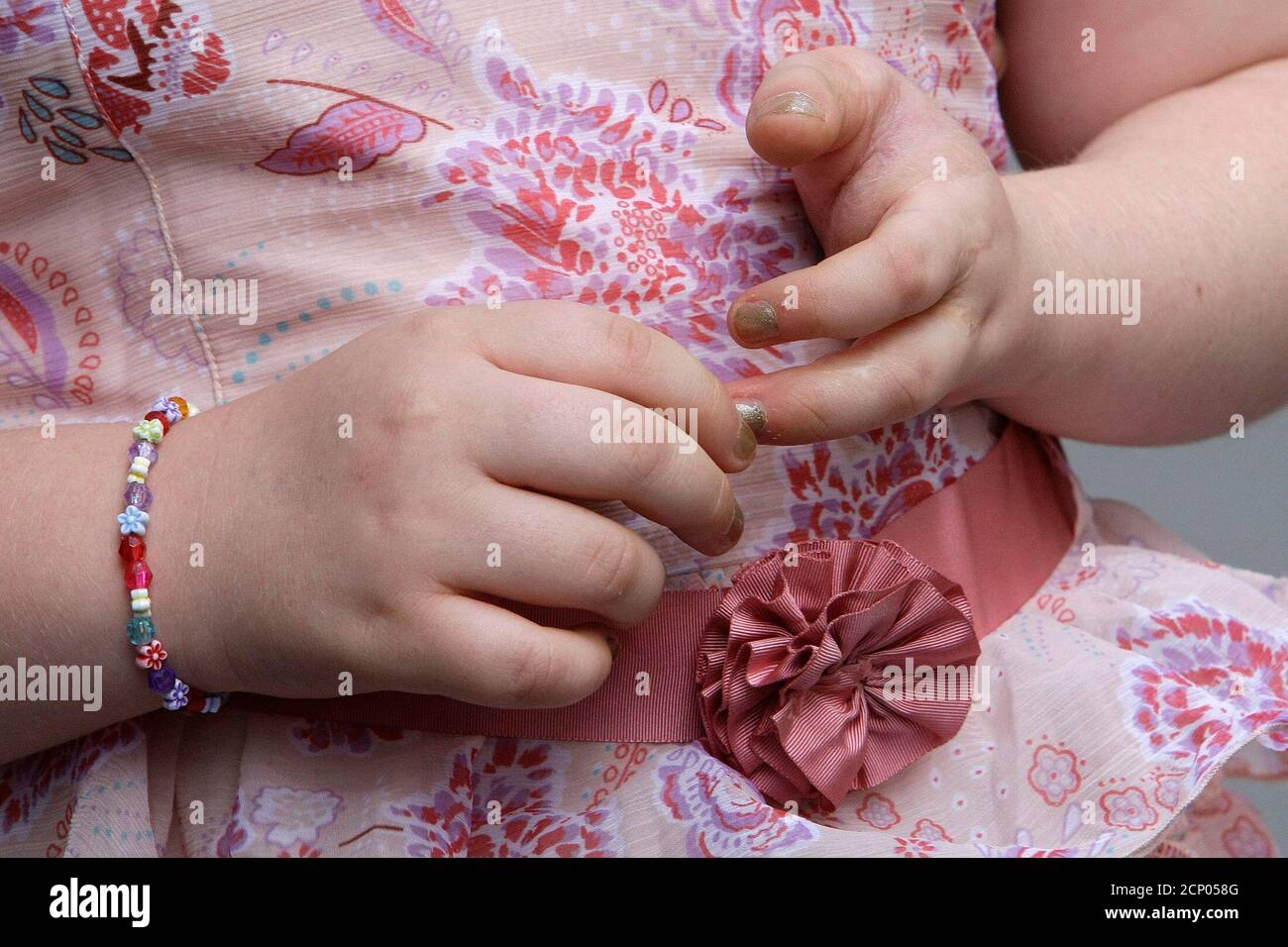 Feet Deformities High Resolution Stock Photography and Images - Alamy