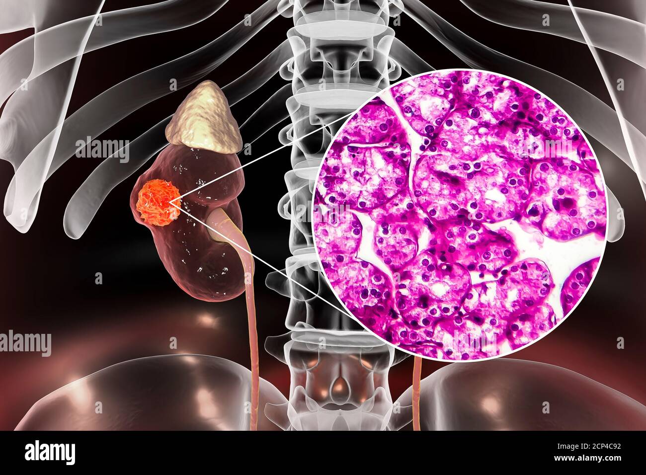 Kidney cancer, computer illustration and light micrograph Stock Photo ...