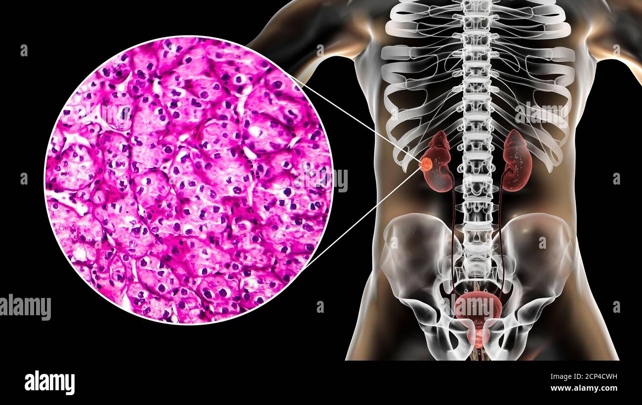 Kidney cancer hi-res stock photography and images - Alamy