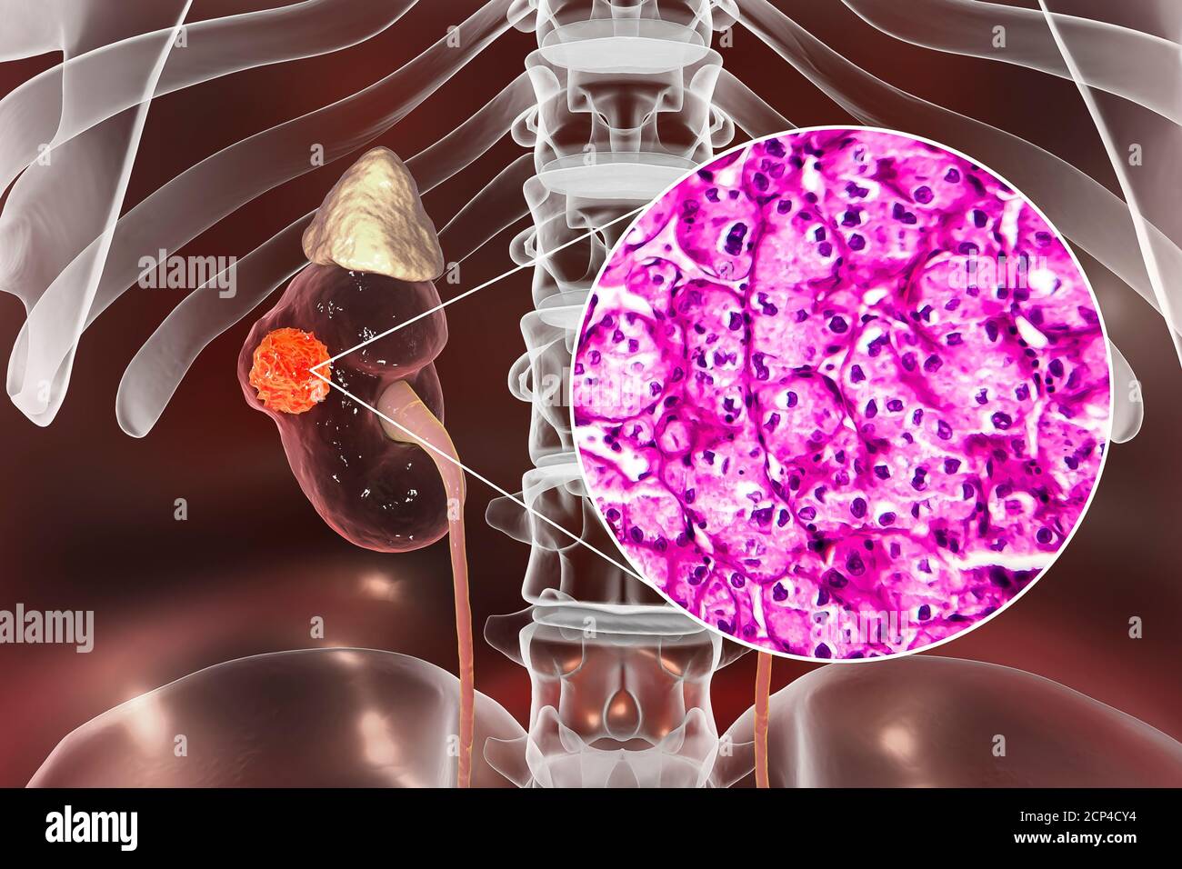 Cancer micrograph hi-res stock photography and images - Alamy