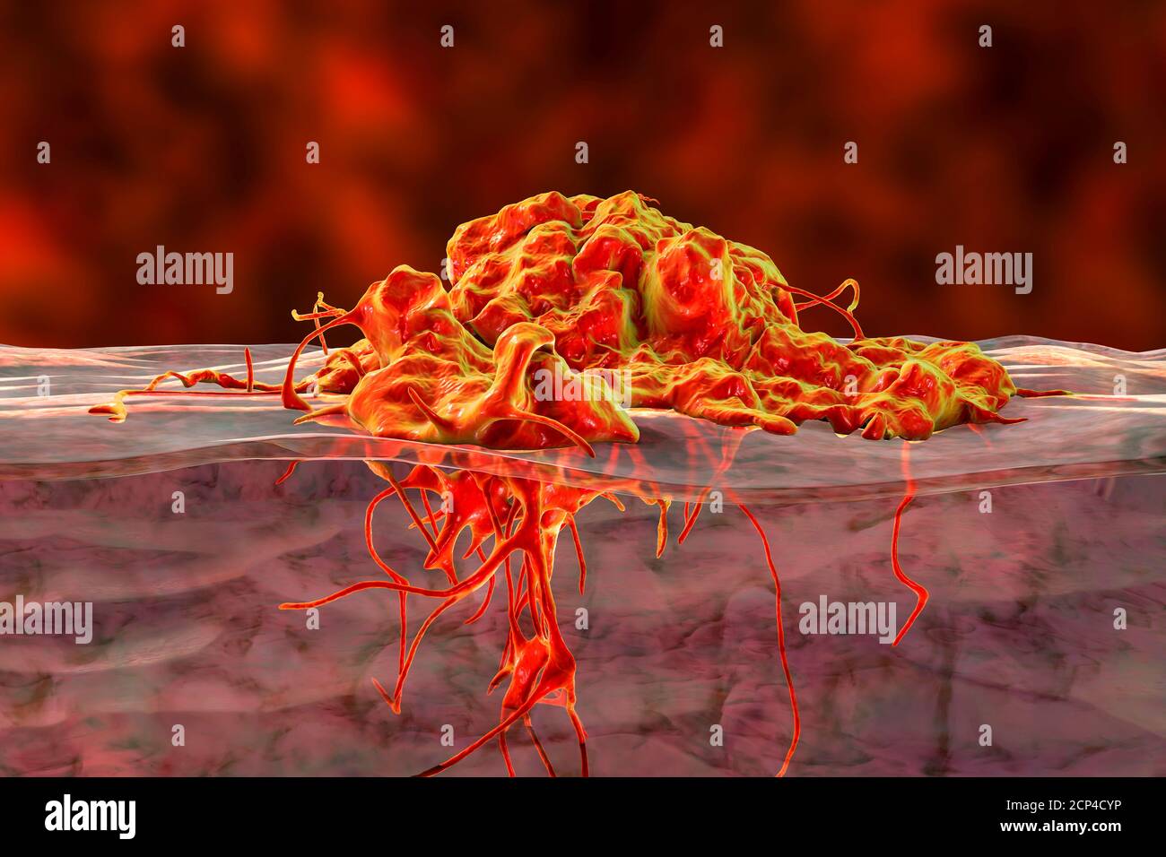 Cancer invasion into surrounding tissues, conceptual computer ...
