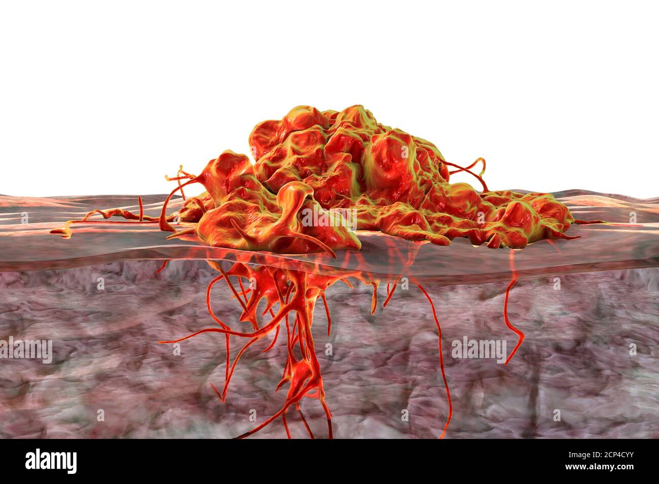 Cancer invasion into surrounding tissues, conceptual computer ...