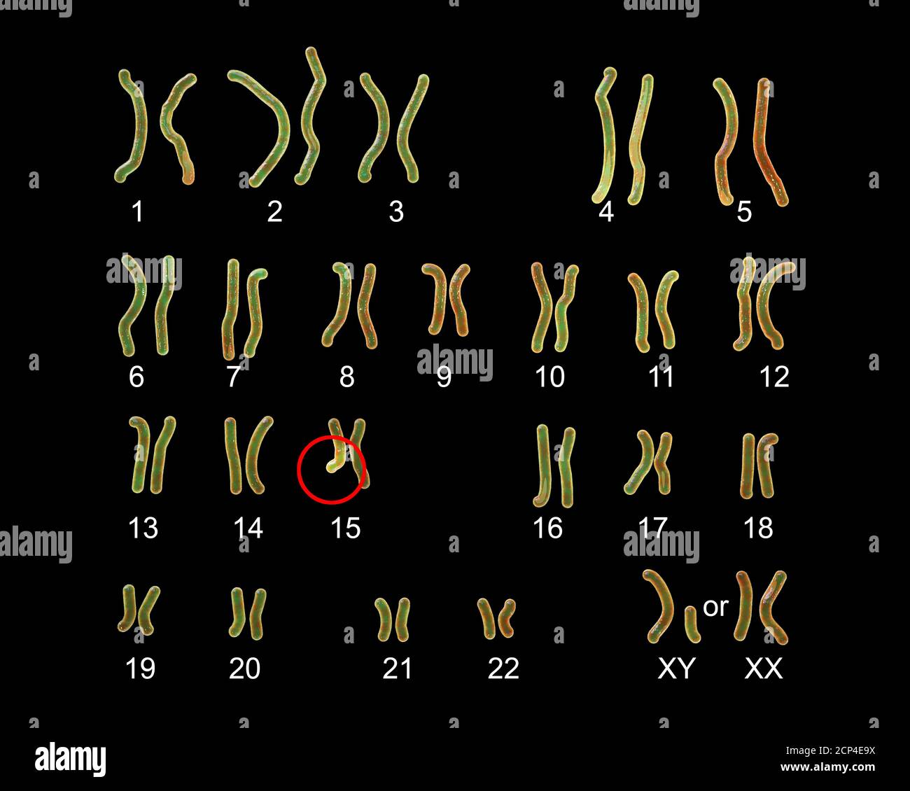Karyotype of Angelman syndrome (AS), computer illustration. AS is a ...