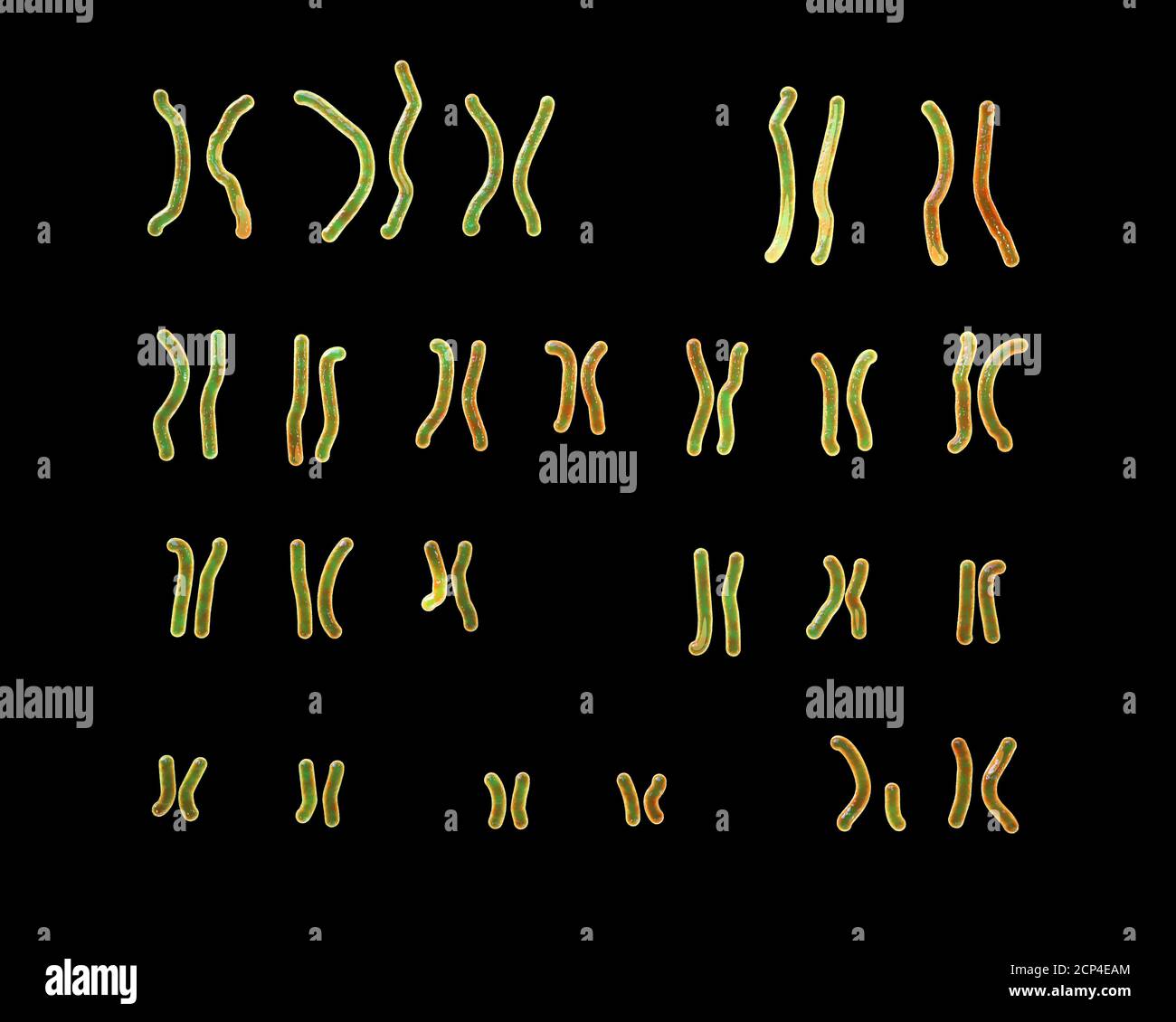 Karyotype of Angelman syndrome (AS), computer illustration. AS is a ...