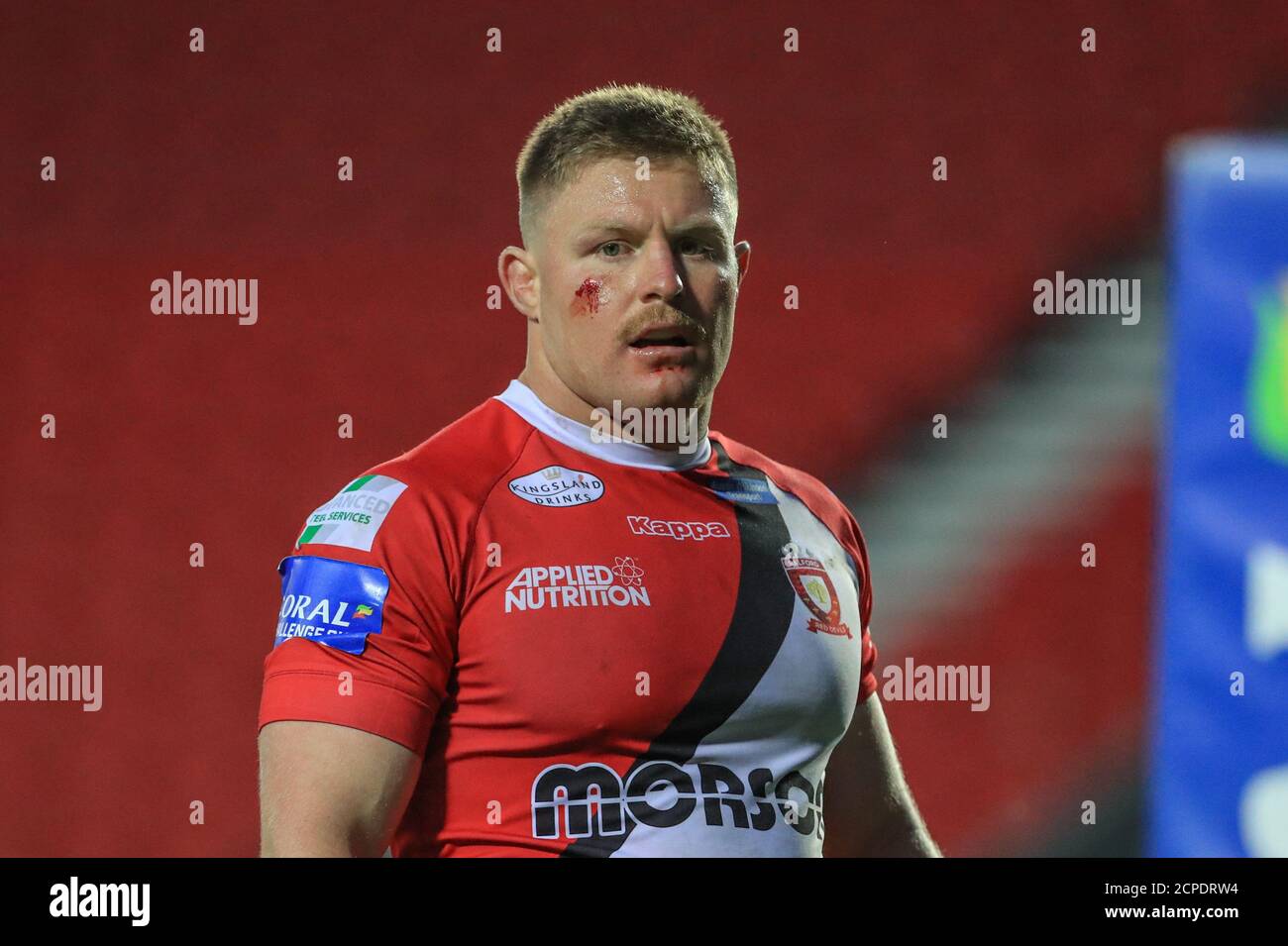Luke Yates of Salford Red Devils receives a cut to his right cheek ...