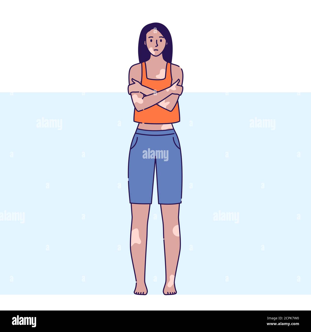 Girl with vitiligo vector illustration. Disease pigment autoimmune ...