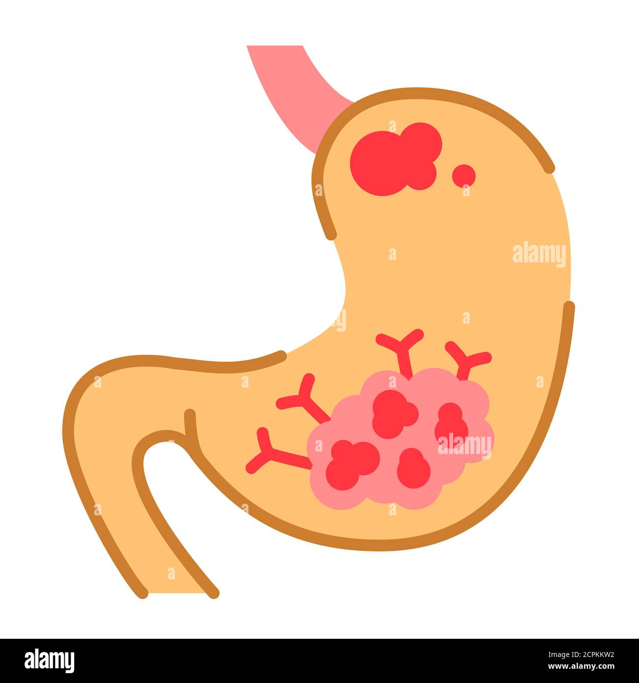 Stomach Cancer Disease Symbol