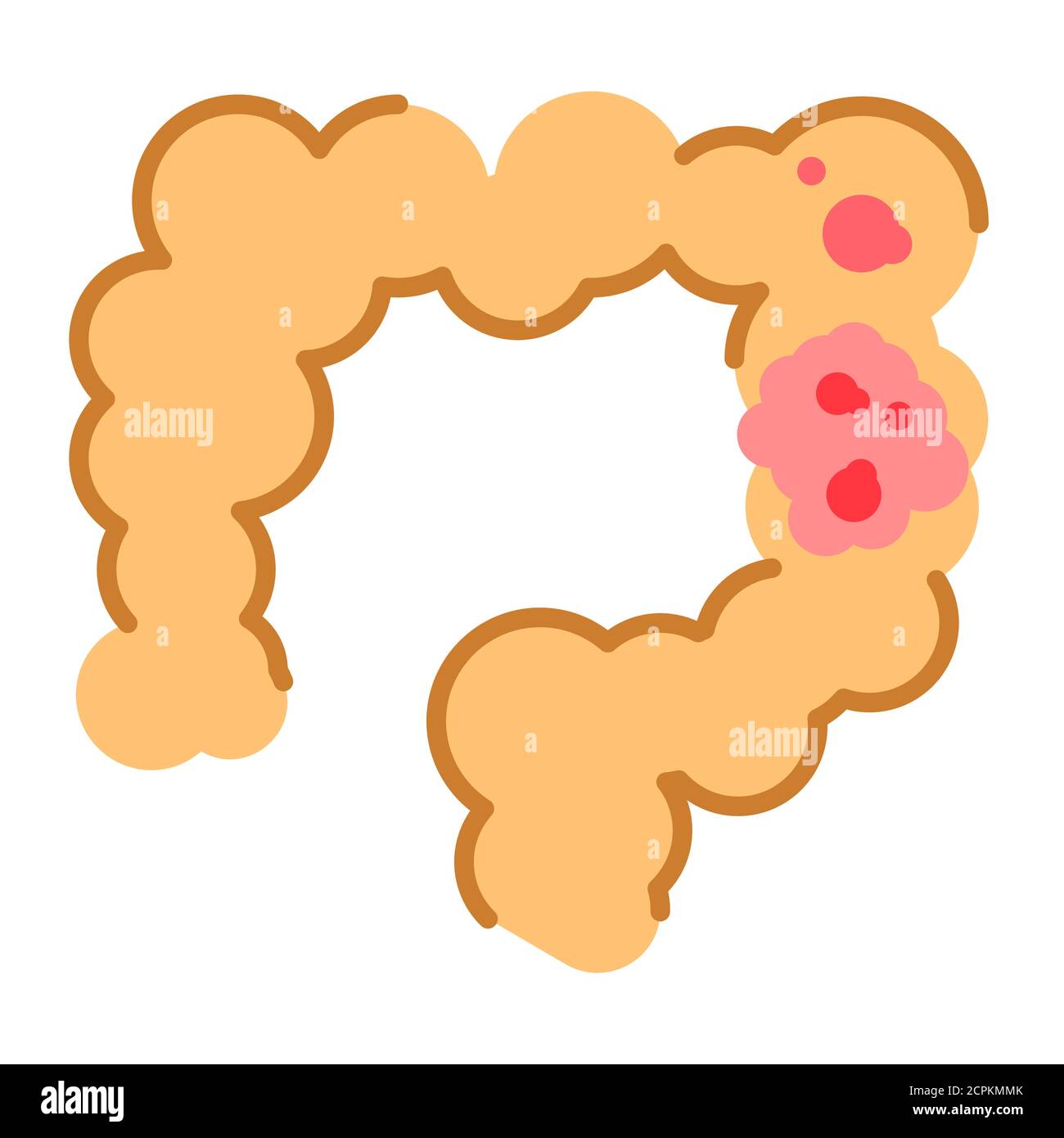 Bowel cancer line color icon. Human organ concept. Malignant neoplasm ...
