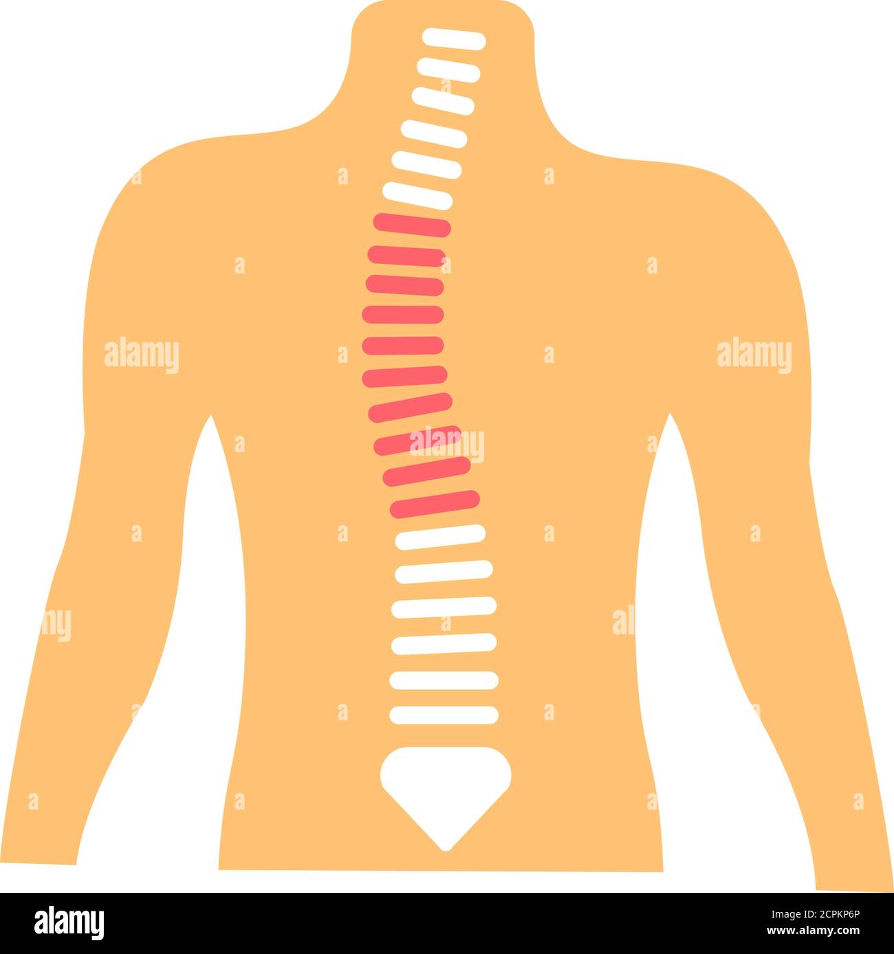 Spinal deformity hi-res stock photography and images - Alamy