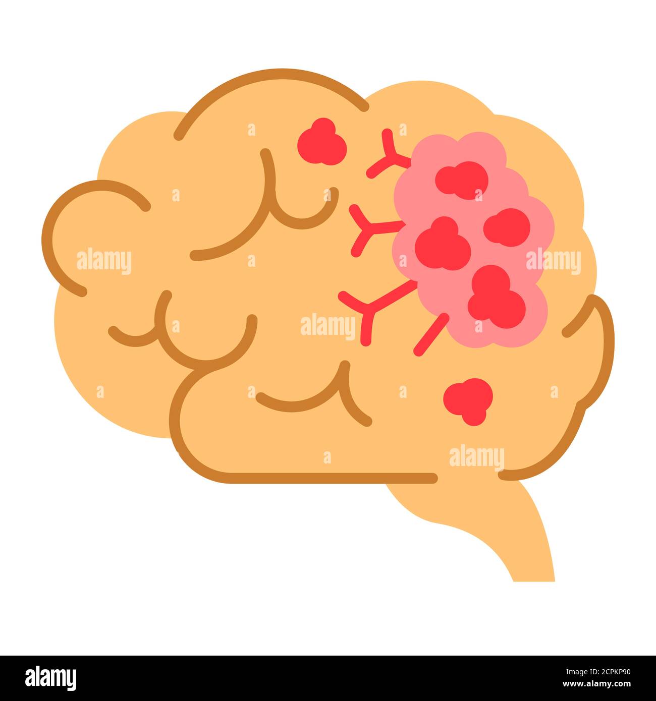Brain Cancer Clip Art