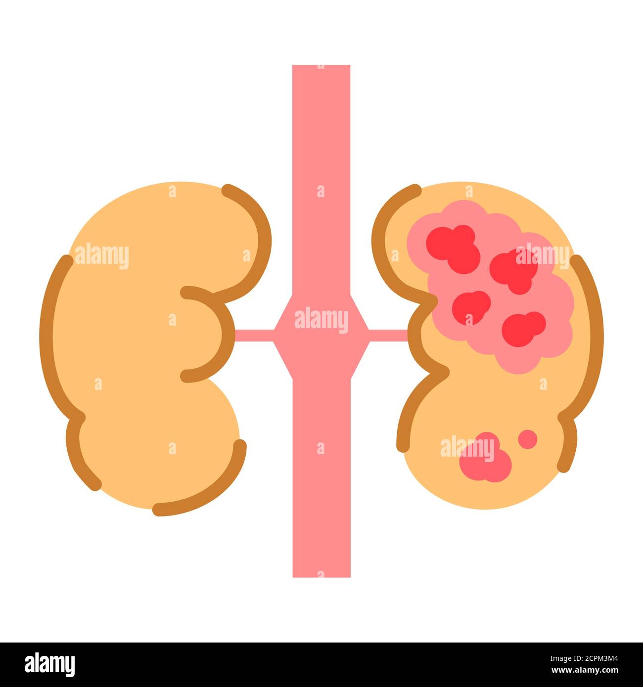 Kidney cancer line color icon. Human organ concept. Malignant neoplasm ...