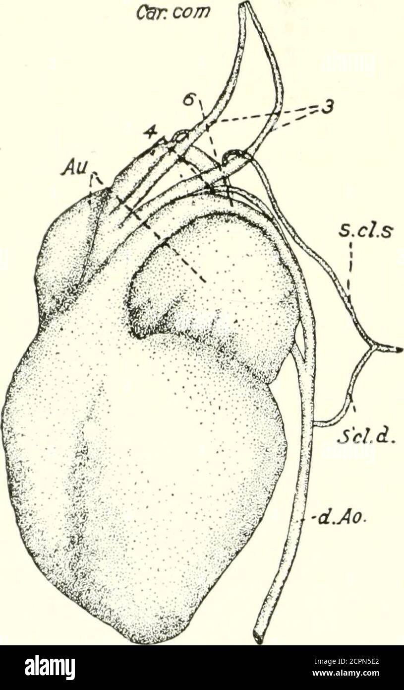 Aortic dissection a hi-res stock photography and images - Alamy