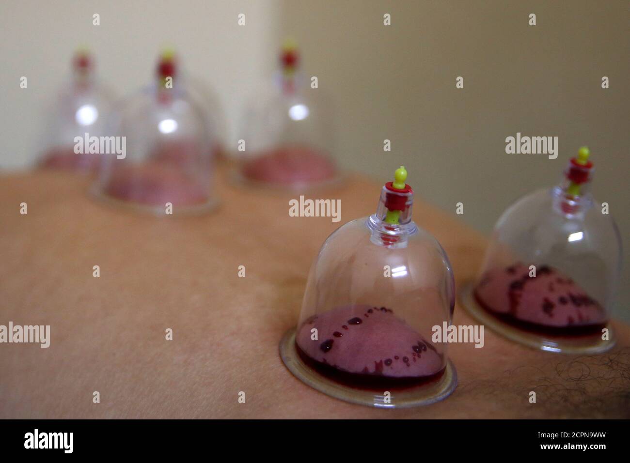Cupping Marks High Resolution Stock Photography and Images - Alamy