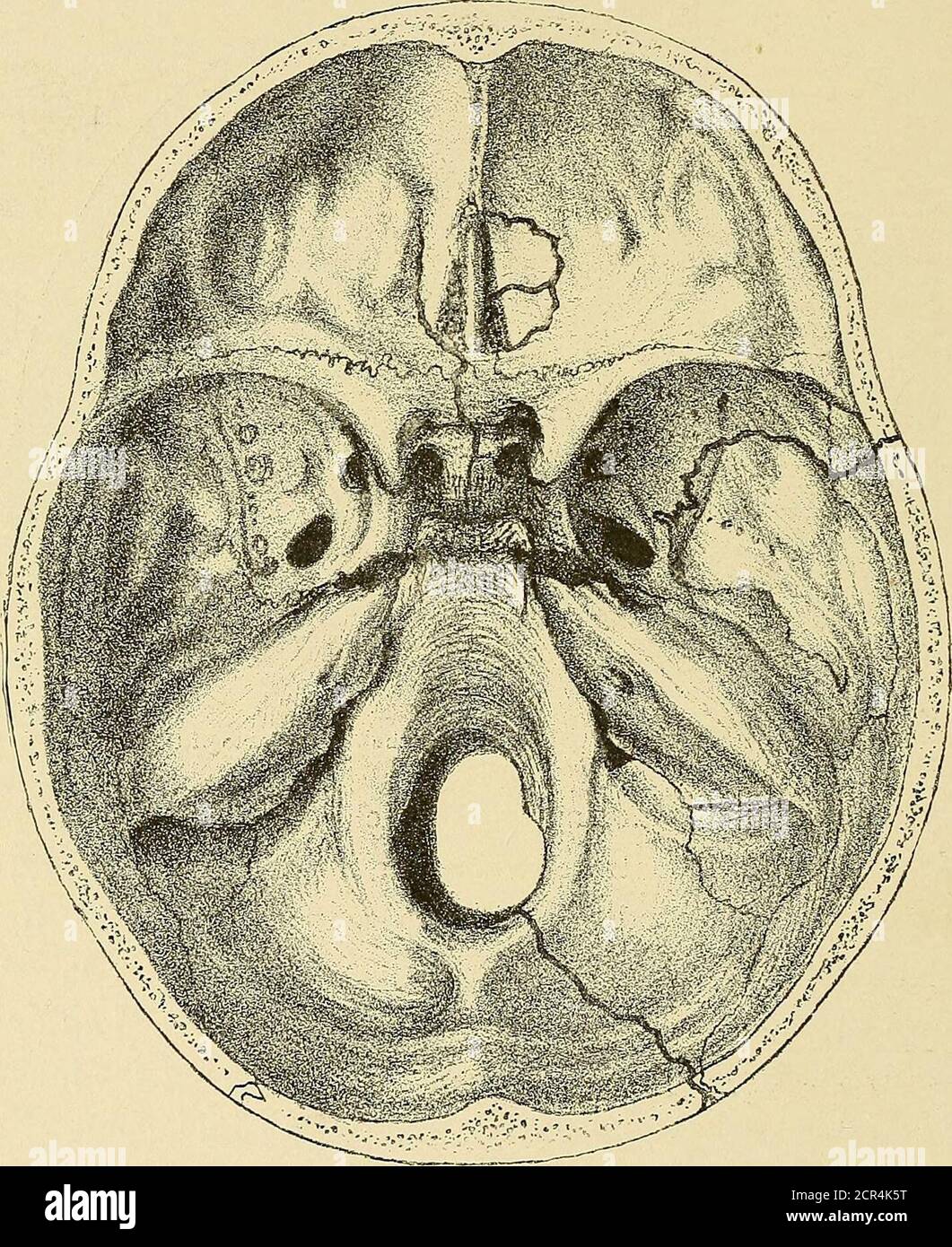 Depression fracture skull hi-res stock photography and images - Alamy