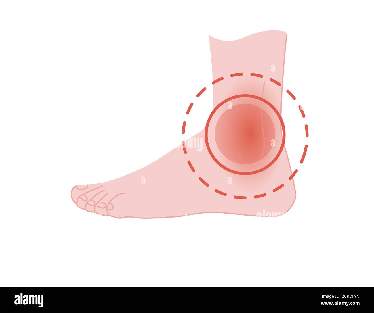 Painful leg foot concept with pain heel red circle cartoon flat design ...