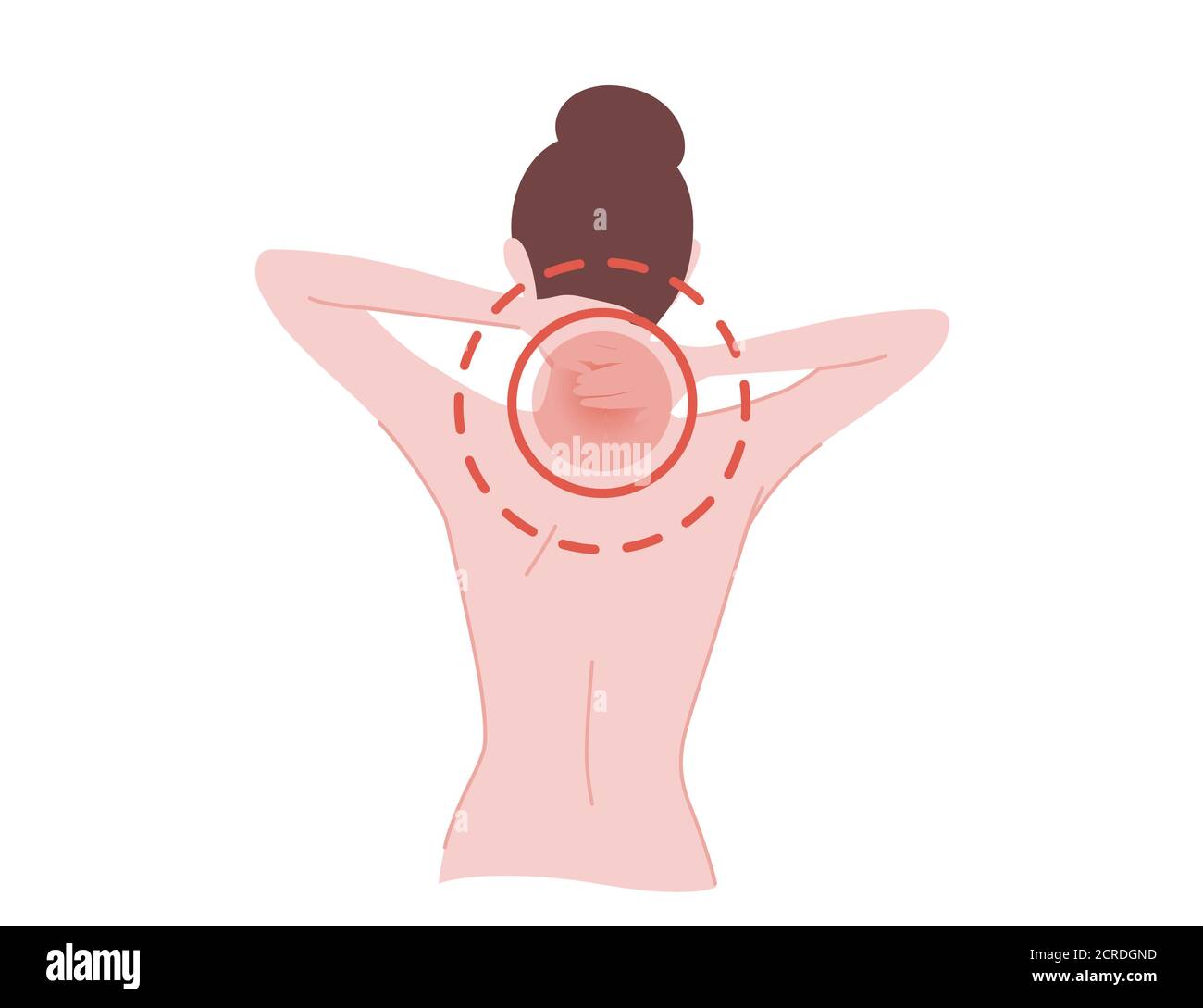 Painful neck concept with human pain circles on back of the neck ... Painful neck concept with human pain circles on back of the neck ...