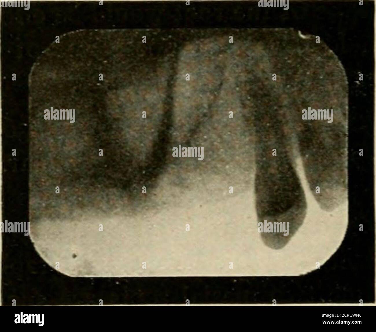 . Elementary and dental radiography / by Howard Riley Raper . Fig. 437 ...
