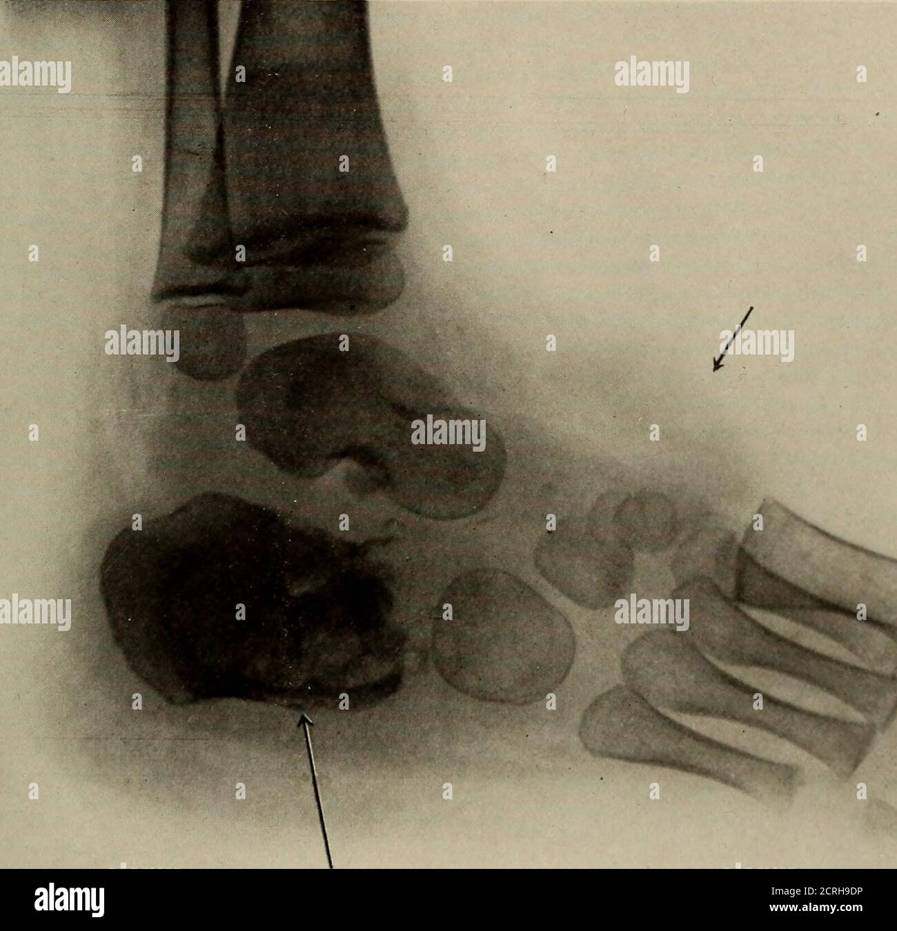 . Living anatomy and pathology; . PLATE 260.TUBERCULOSIS OF THE OS ...