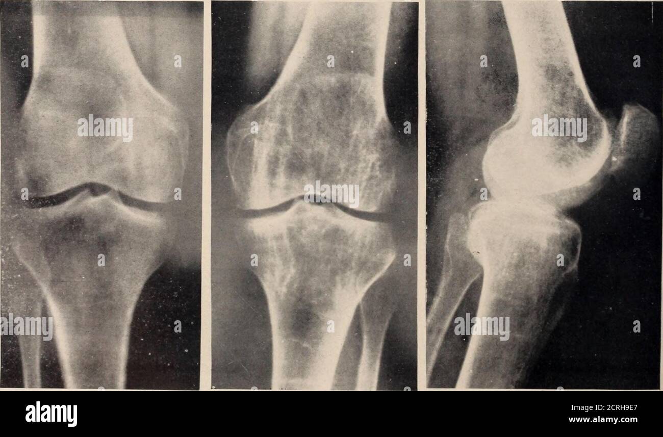 Normal ankle joint x ray hi-res stock photography and images - Alamy