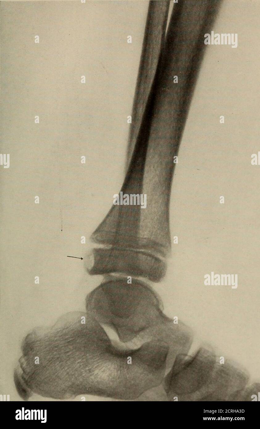 . Living anatomy and pathology; . PLATE 259.TUBERCULOSIS OF THE ...
