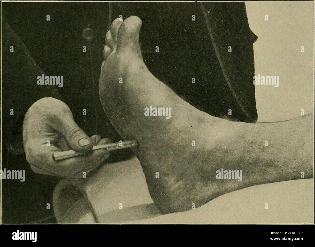 Paraplegic Legs Atrophy