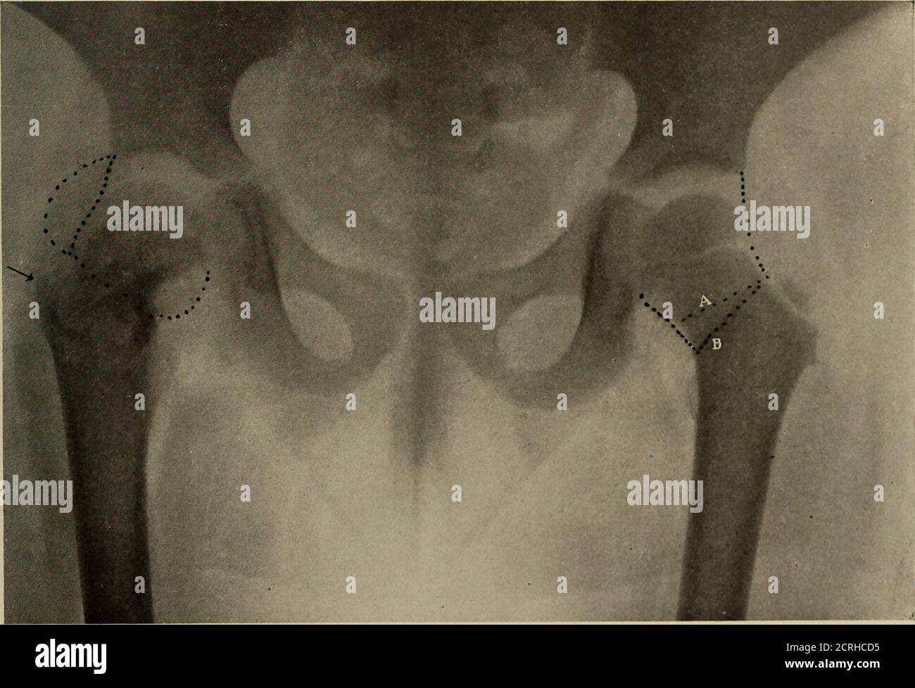 . Living anatomy and pathology; . PLATE 254.AN INFECTIOUS PROCESS IN ...