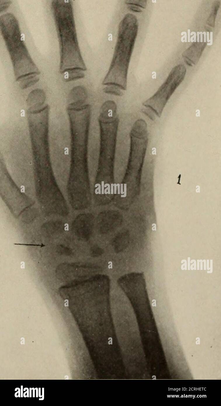 . Living anatomy and pathology; . PLATE 248.TUBERCULOSIS IN ELBOW-JOINT ...