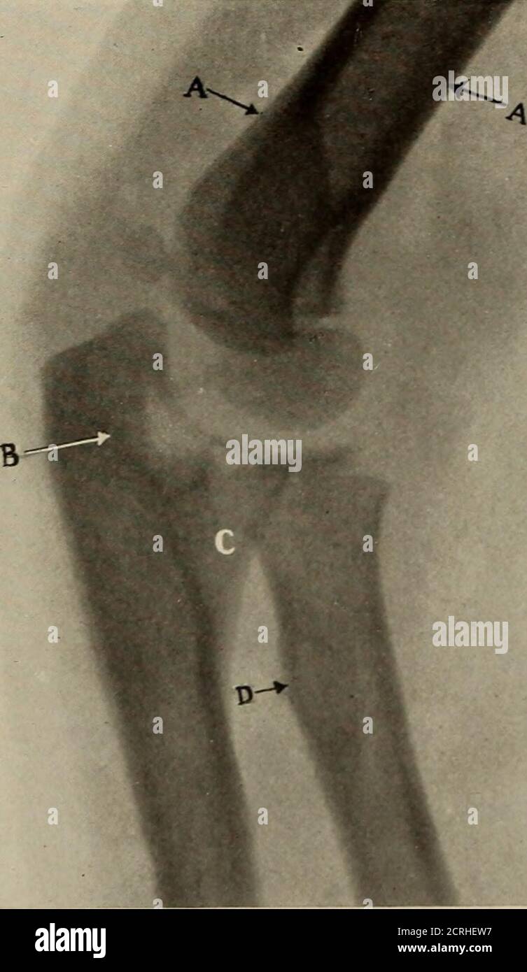 . Living anatomy and pathology; . PLATE 248.TUBERCULOSIS IN ELBOW-JOINT ...