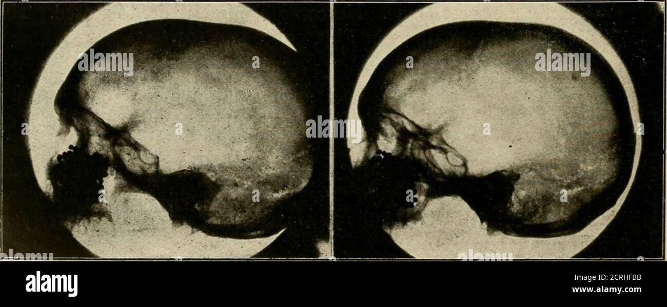 . Elementary and dental radiography / by Howard Riley Raper . Fig. 345 ...