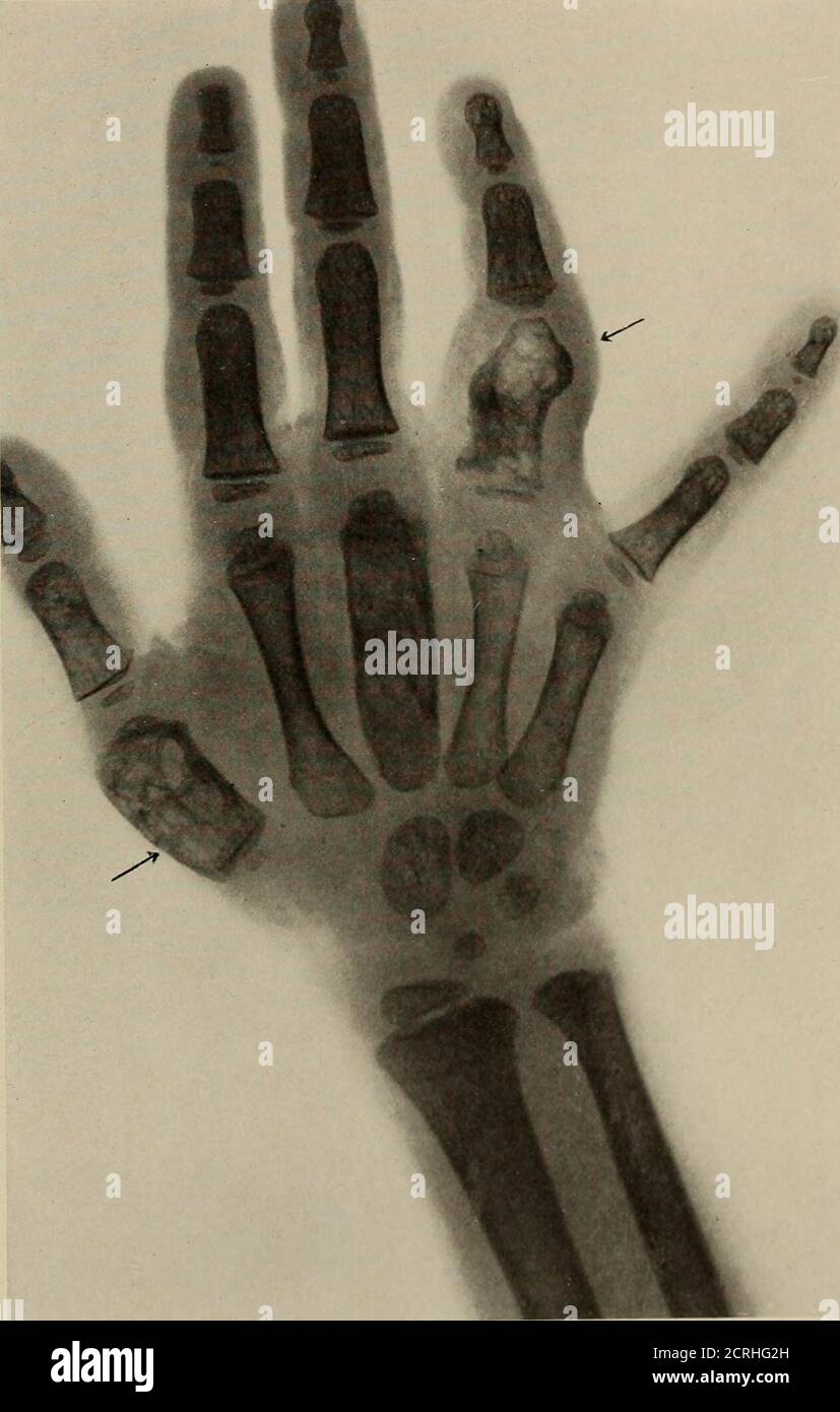 . Living anatomy and pathology; . PLATE 245.TUBERCULAR DACTYLITIS ...