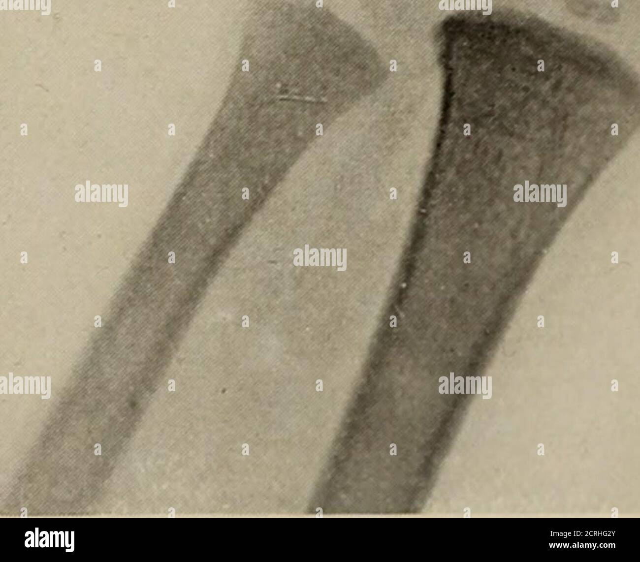 . Living anatomy and pathology; . PLATE 245.TUBERCULAR DACTYLITIS ...