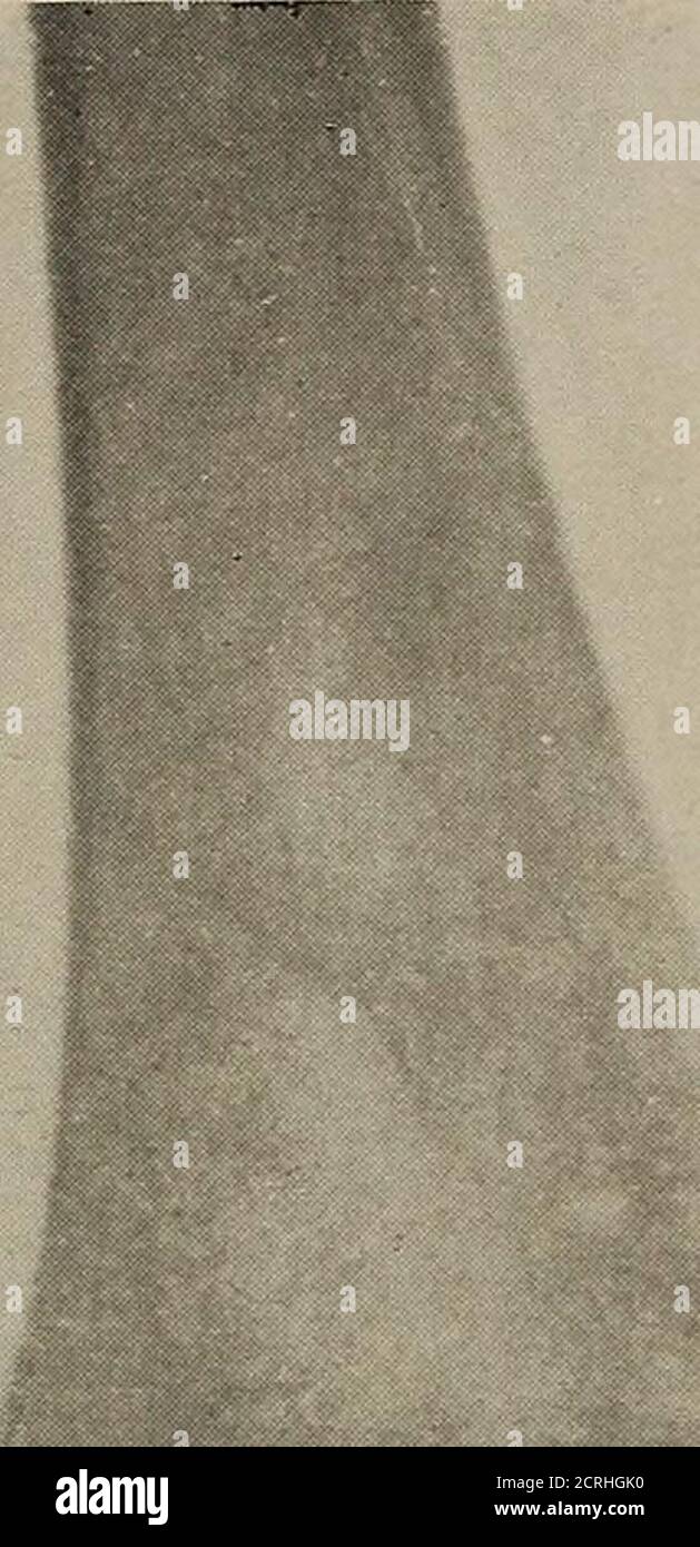 . Living anatomy and pathology; . PLATE 243.ATROPHY OF KNEE FROM DISUSE ...