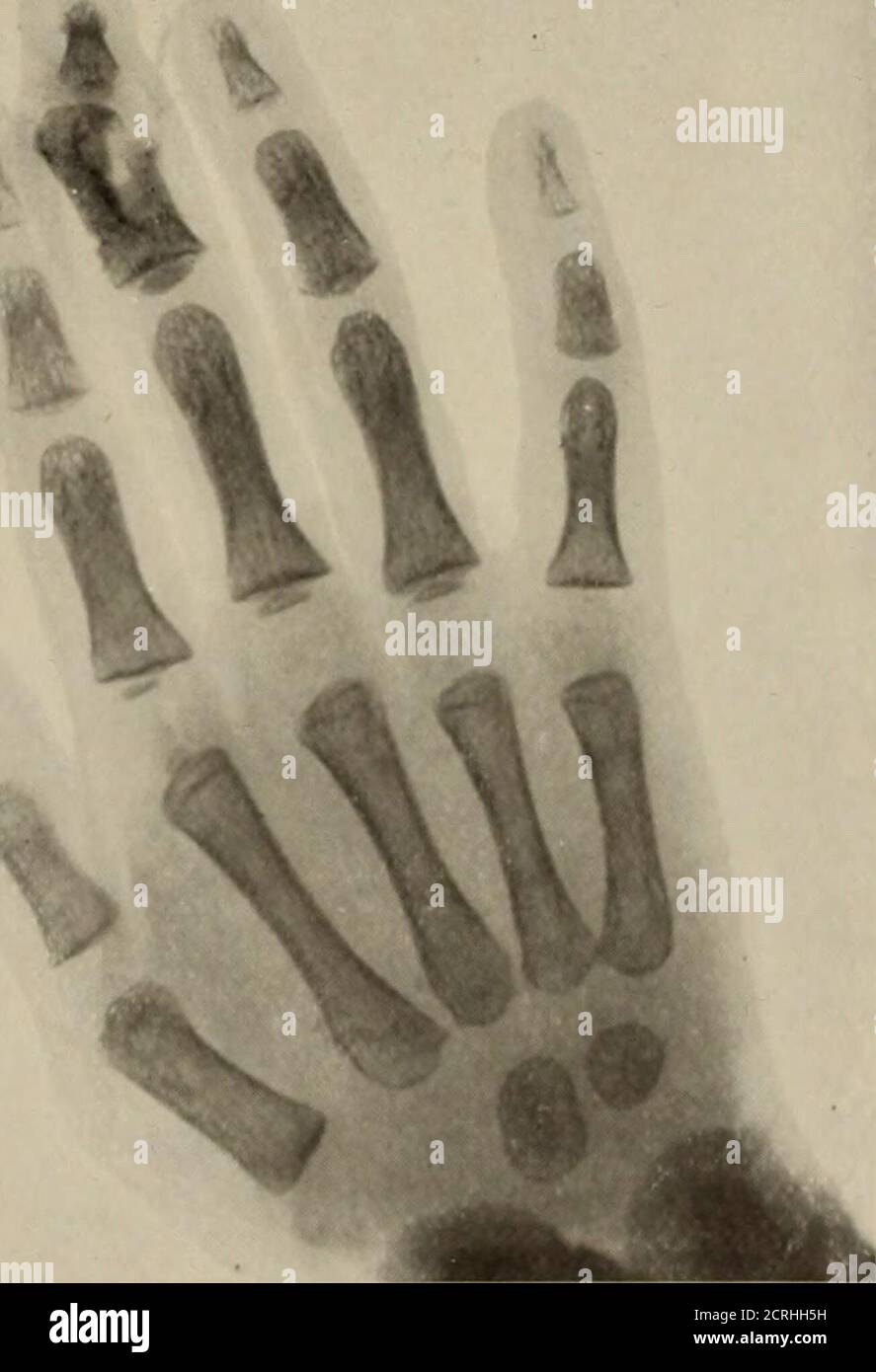 Epiphyses of the femur hi-res stock photography and images - Alamy