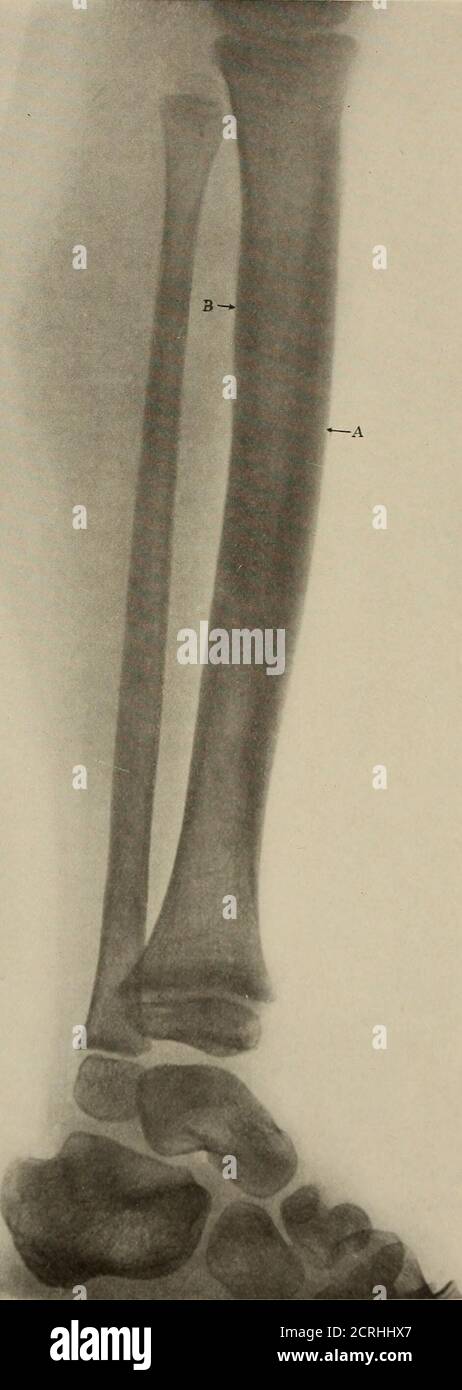. Living anatomy and pathology; . PLATE 238.SYPHILITIC PERIOSTITIS ...