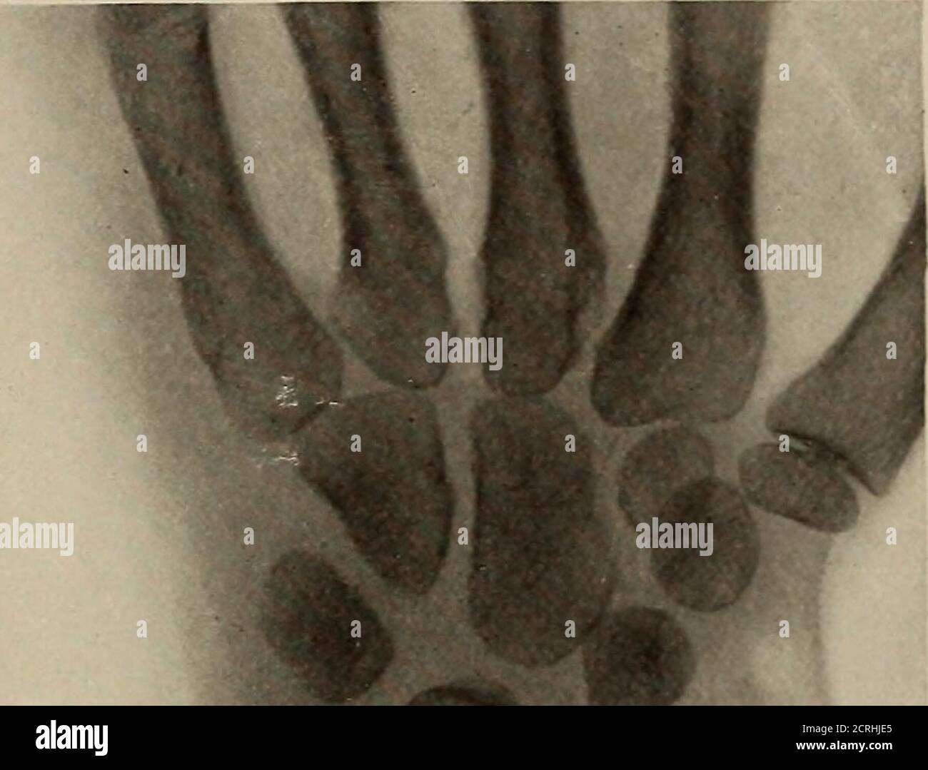 Dactylitis hi-res stock photography and images - Alamy