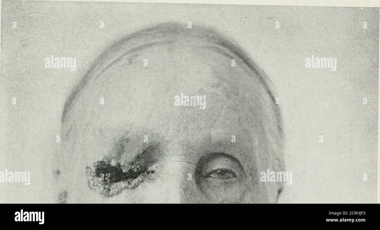 Rodent ulcer High Resolution Stock Photography and Images - Alamy