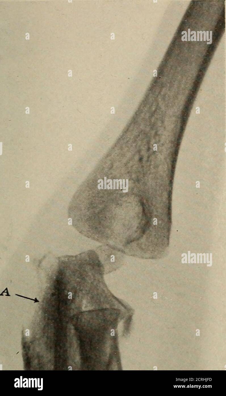 . Living anatomy and pathology; . PLATE 236. Fig. 1. Syphilis of the ...