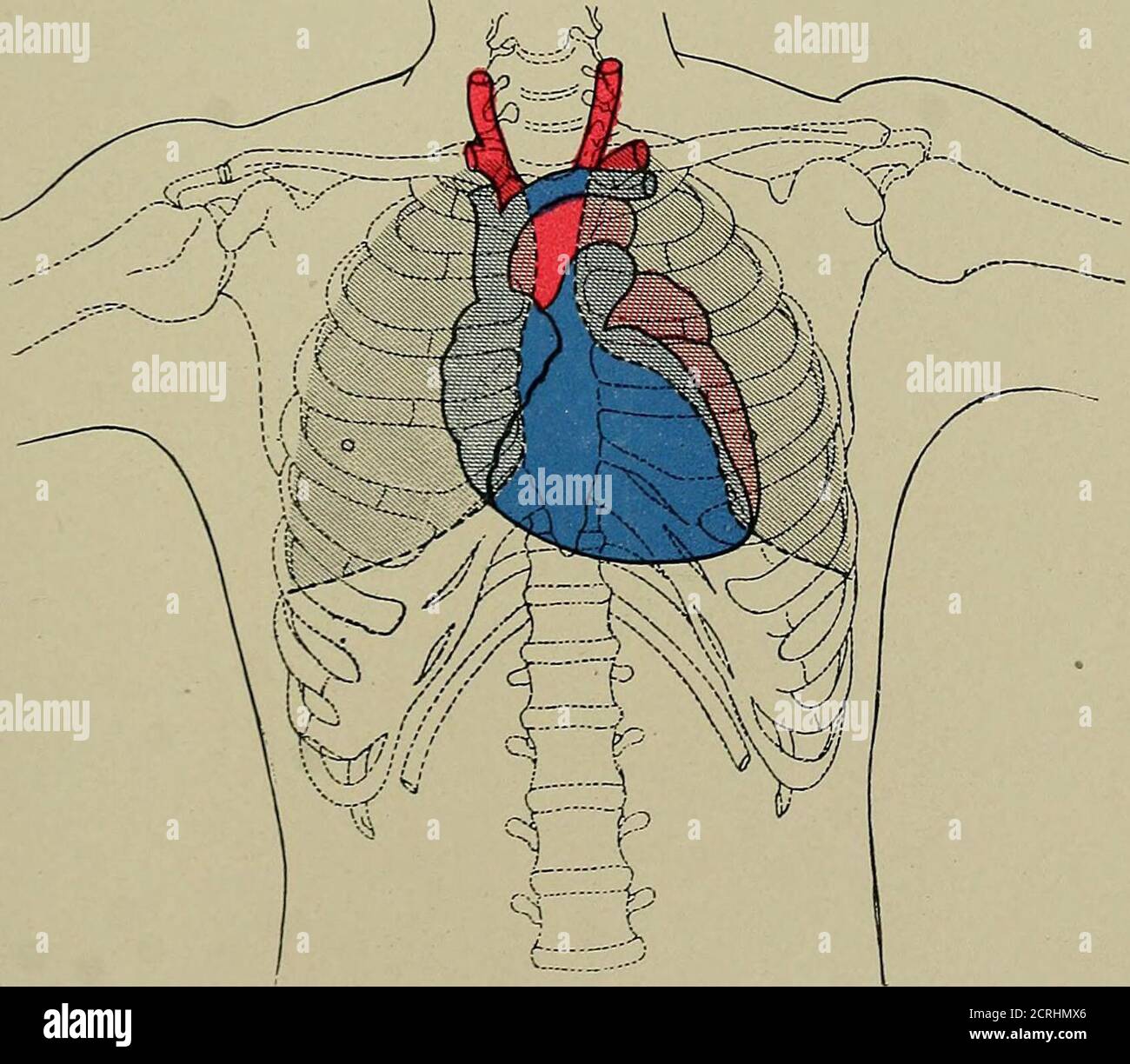 Cardiac hypertrophy hi-res stock photography and images - Alamy
